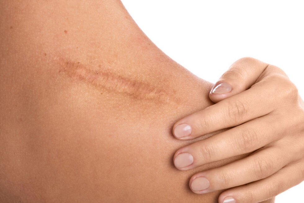 Scar Treatment - Welcome to DMSI - Professional Surgical Dermatology ...